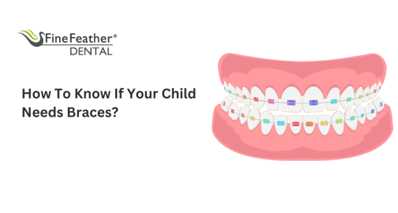 How To Know If Your Child Needs Braces? | Fine Feather